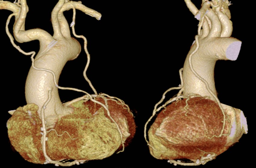 低侵襲冠動脈バイパス術（MICS CABG）とは？ ～身体への負担が少ない小さな傷で行う新しい冠動脈バイパス手術～ | 東京Dタワーホスピタル ...