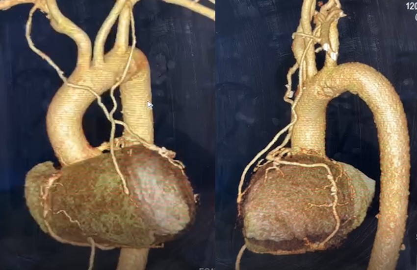 低侵襲冠動脈バイパス術（MICS CABG）とは？ ～身体への負担が少ない小さな傷で行う新しい冠動脈バイパス手術～ | 東京Dタワーホスピタル ...