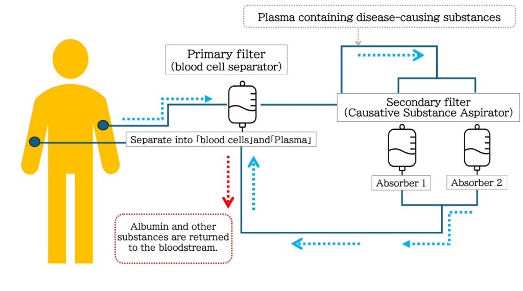 LDL apheresis blood purification therapy | 東京Dタワーホスピタル｜江東区豊洲の病院